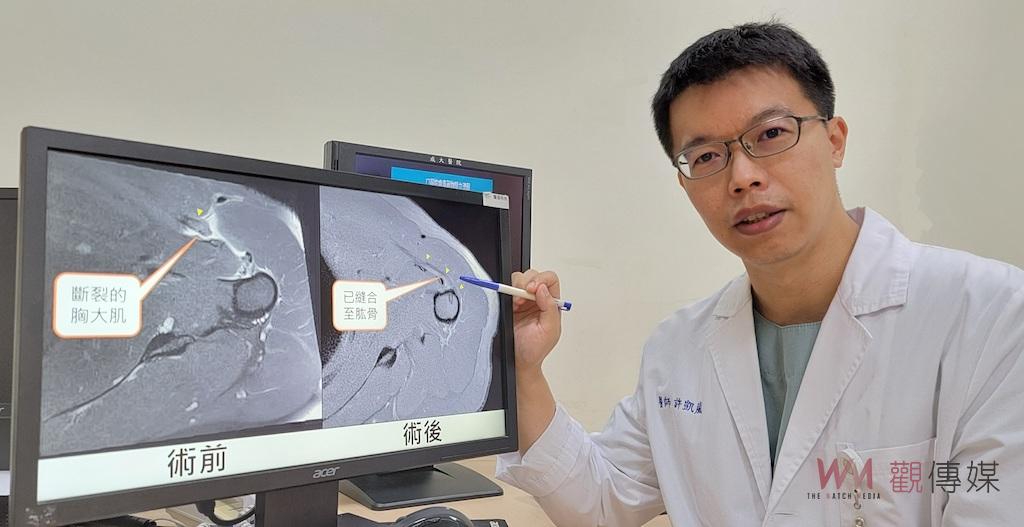 觀傳媒 雲嘉南新聞 壯男健身胸大肌突斷裂 醫師重訓要量力而為
